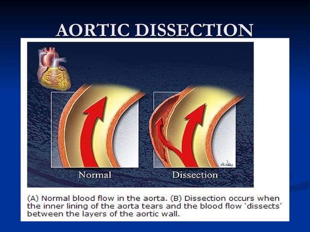 HYPERTENSION and classification and pathology | PPT