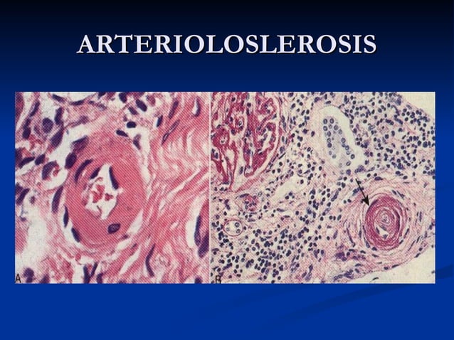 HYPERTENSION and classification and pathology | PPT