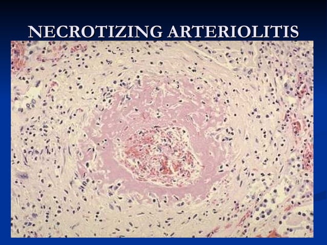 HYPERTENSION and classification and pathology | PPT