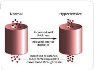Hypertension | PPT