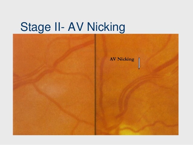 Hypertension - Approach & Management