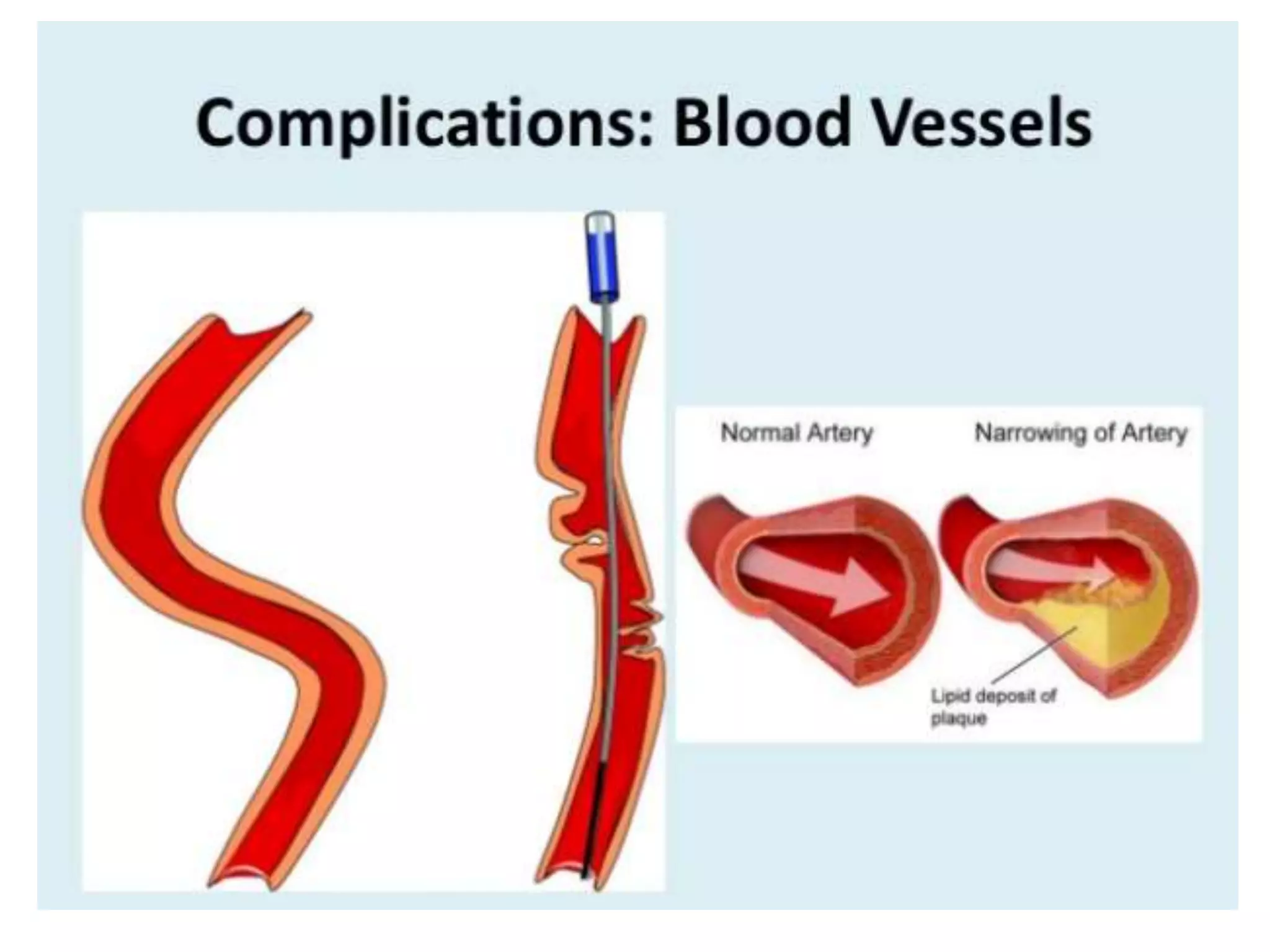 Hypertension – Clinical features and complications.pptx
