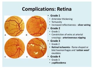 Hypertension – Clinical features and complications.pptx