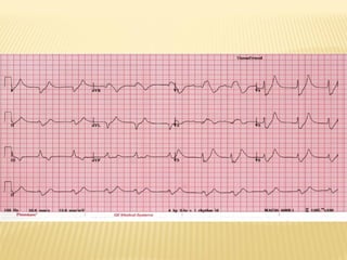 hypertension End Organ Damage with hemorhage | PPT