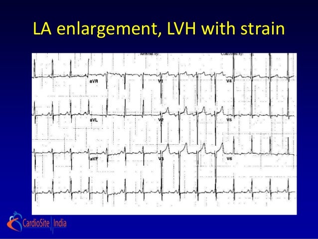 Hypertension & heart