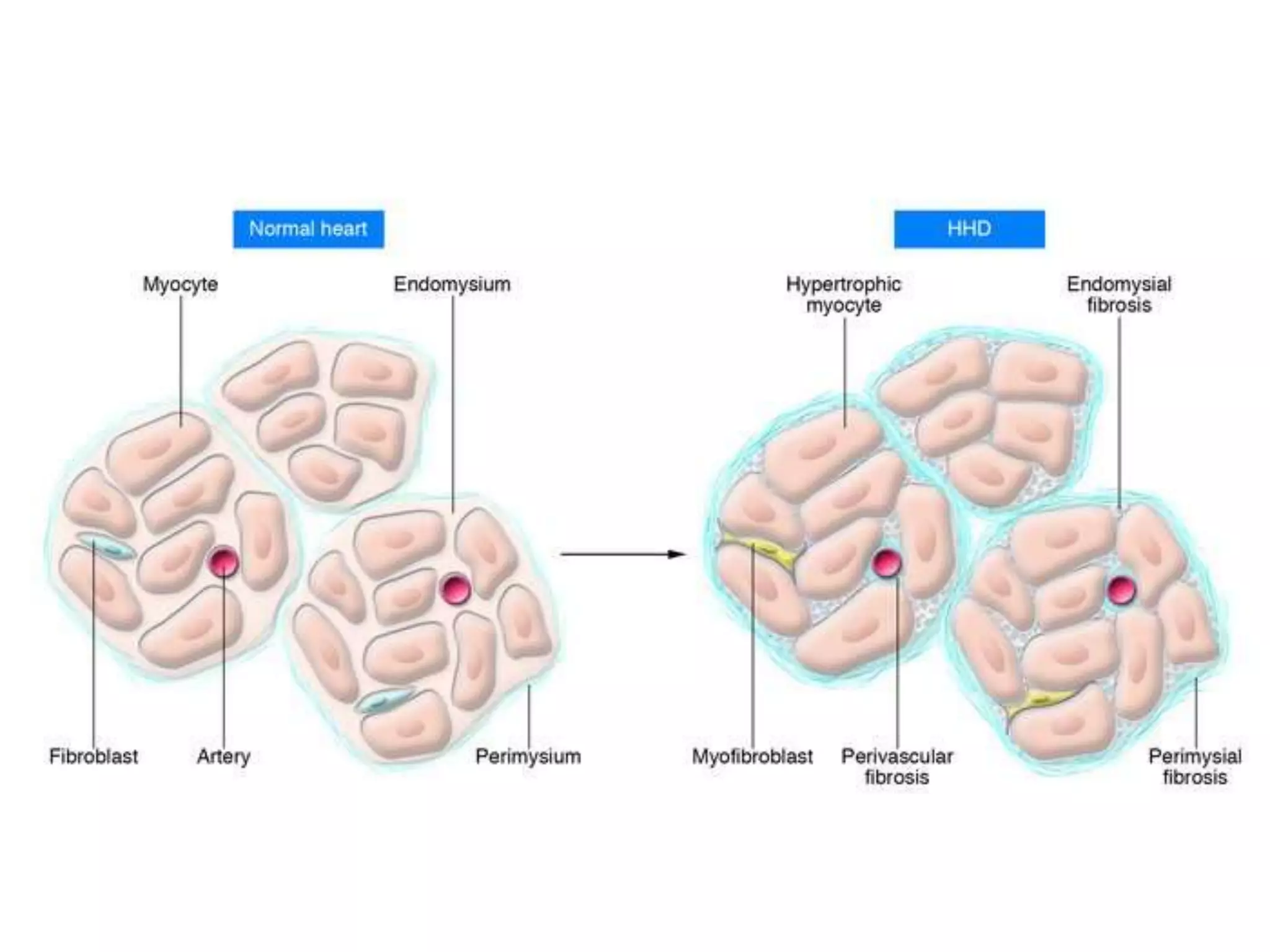 Hypertensive heart disease (hhd) | PPTX