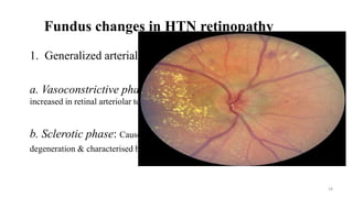 Hypertensive Retinopathy | PPTX