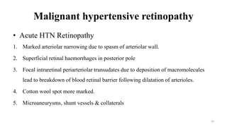 Hypertensive Retinopathy | PPTX