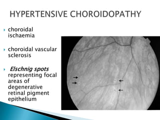 Hypertension and ocular changes | PPTX