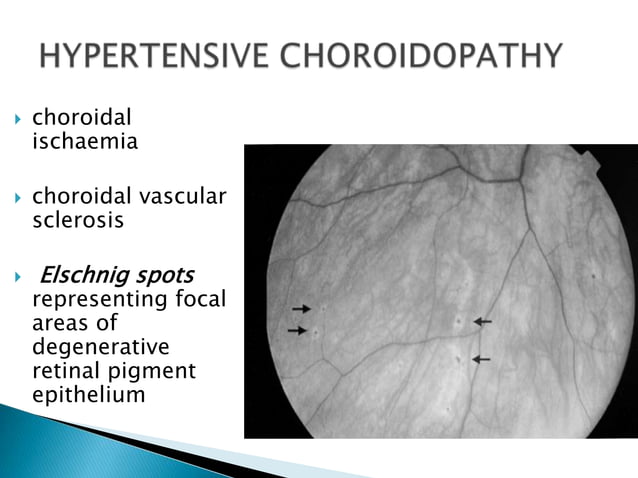 Hypertension and ocular changes | PPTX | Eye and Vision Conditions ...
