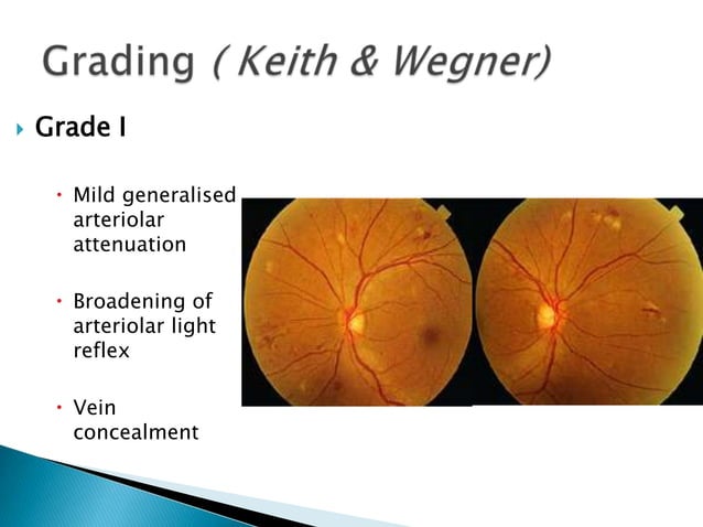 Hypertension and ocular changes | PPTX | Eye and Vision Conditions | Diseases and Conditions