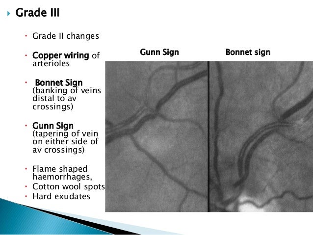 Hypertension and ocular changes