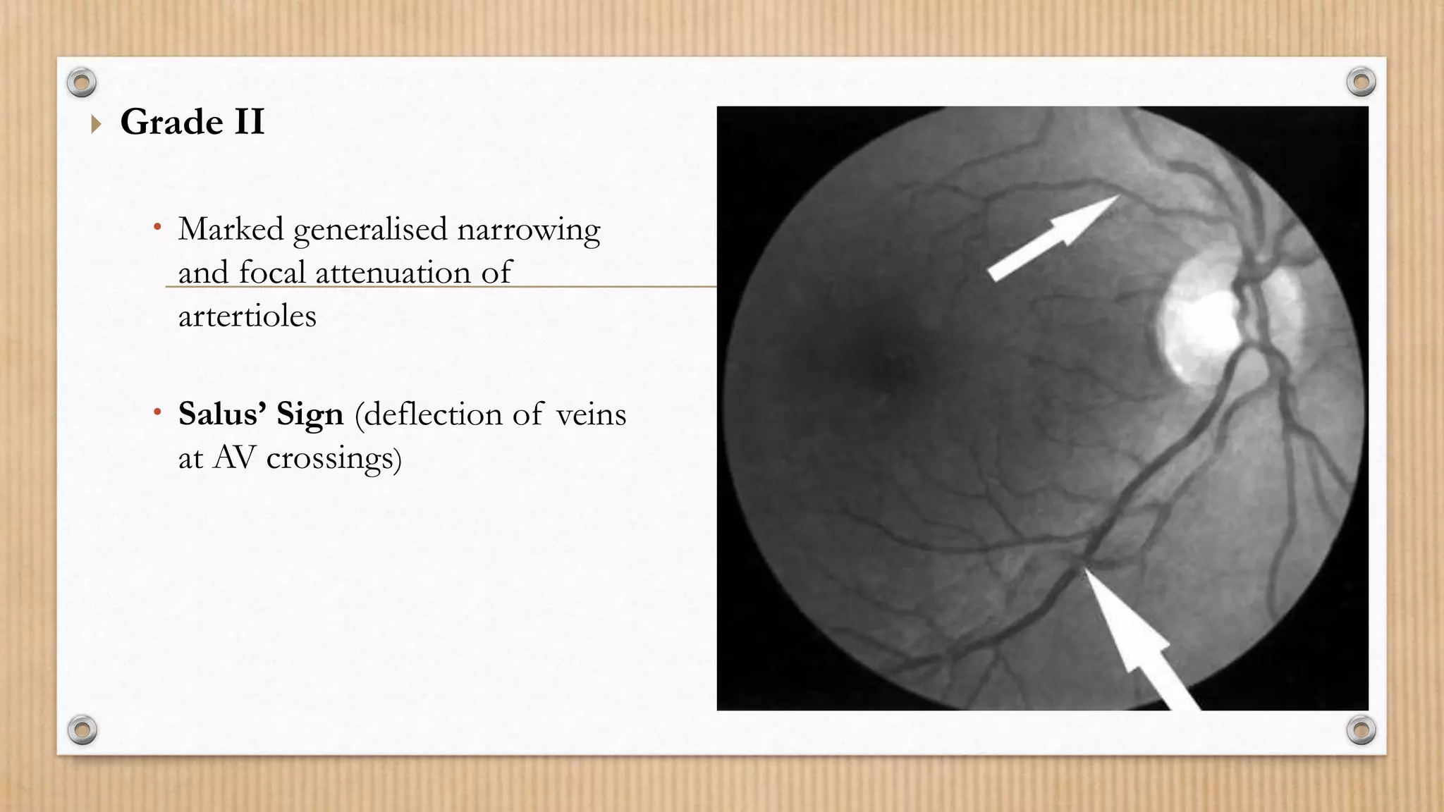 Hypertensive retinopathy | PPTX