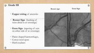 Hypertensive retinopathy | PPTX