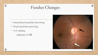 Hypertensive retinopathy | PPTX