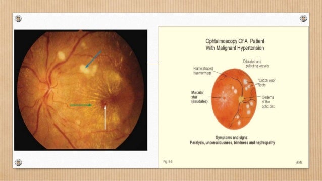 Hypertensive retinopathy
