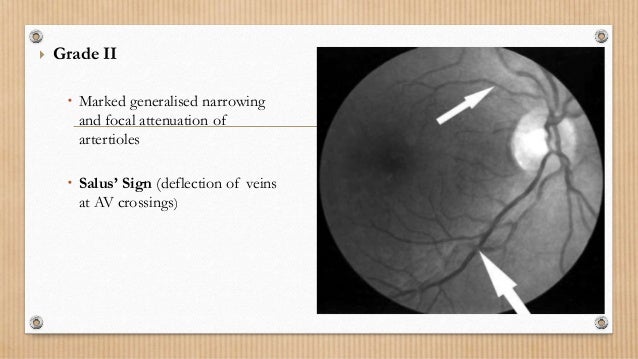 Hypertensive retinopathy