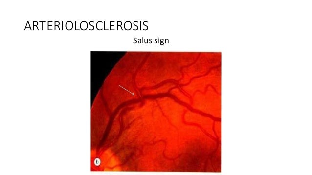 Hypertensive retinopathy