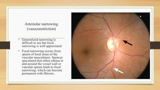 Hypertensive retinopathy | PPT