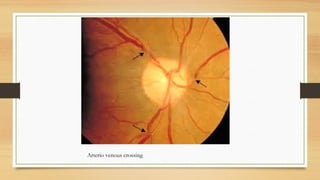 Hypertensive retinopathy | PPT
