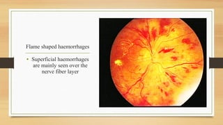 Hypertensive retinopathy | PPT