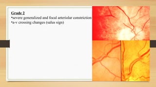 Hypertensive retinopathy | PPT