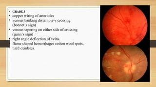 Hypertensive retinopathy | PPT