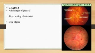 Hypertensive retinopathy | PPT