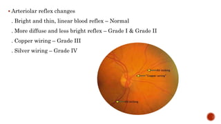 Hypertensive retinopathy | PPTX