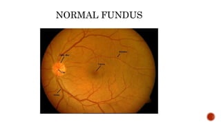 Hypertensive retinopathy | PPTX