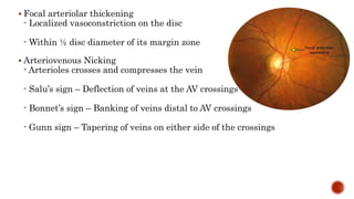 Hypertensive retinopathy | PPTX
