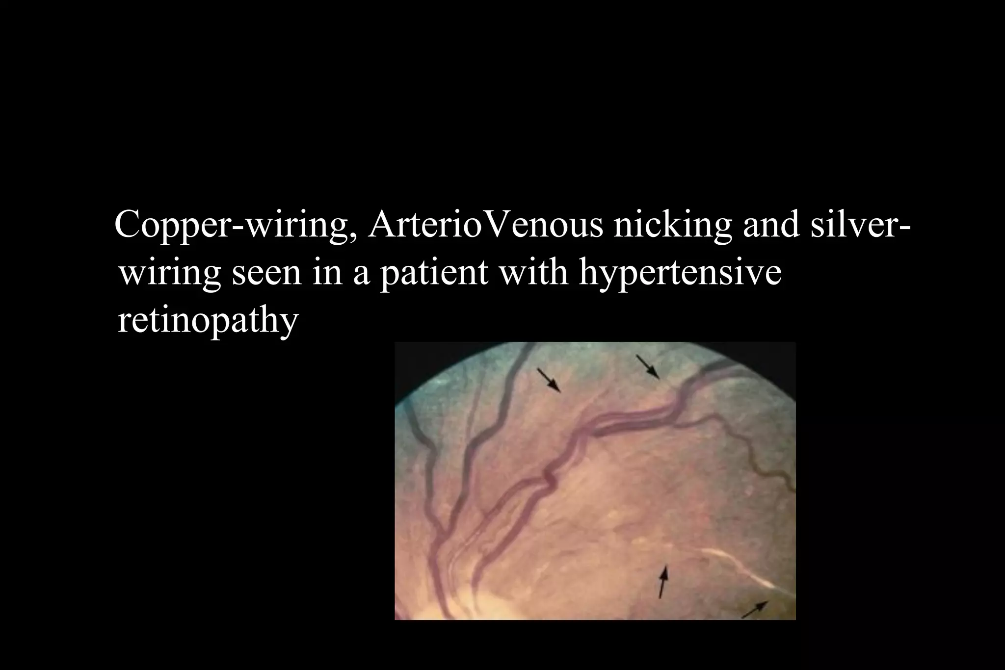 Hypertensive retinopathy,Dr M SAQUIB | PDF