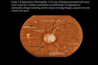 Hypertensive retinopathy,Dr M SAQUIB | PDF
