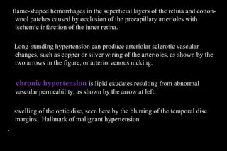 Hypertensive retinopathy,Dr M SAQUIB | PDF