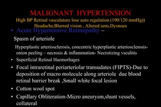 Hypertensive retinopathy,Dr M SAQUIB | PDF