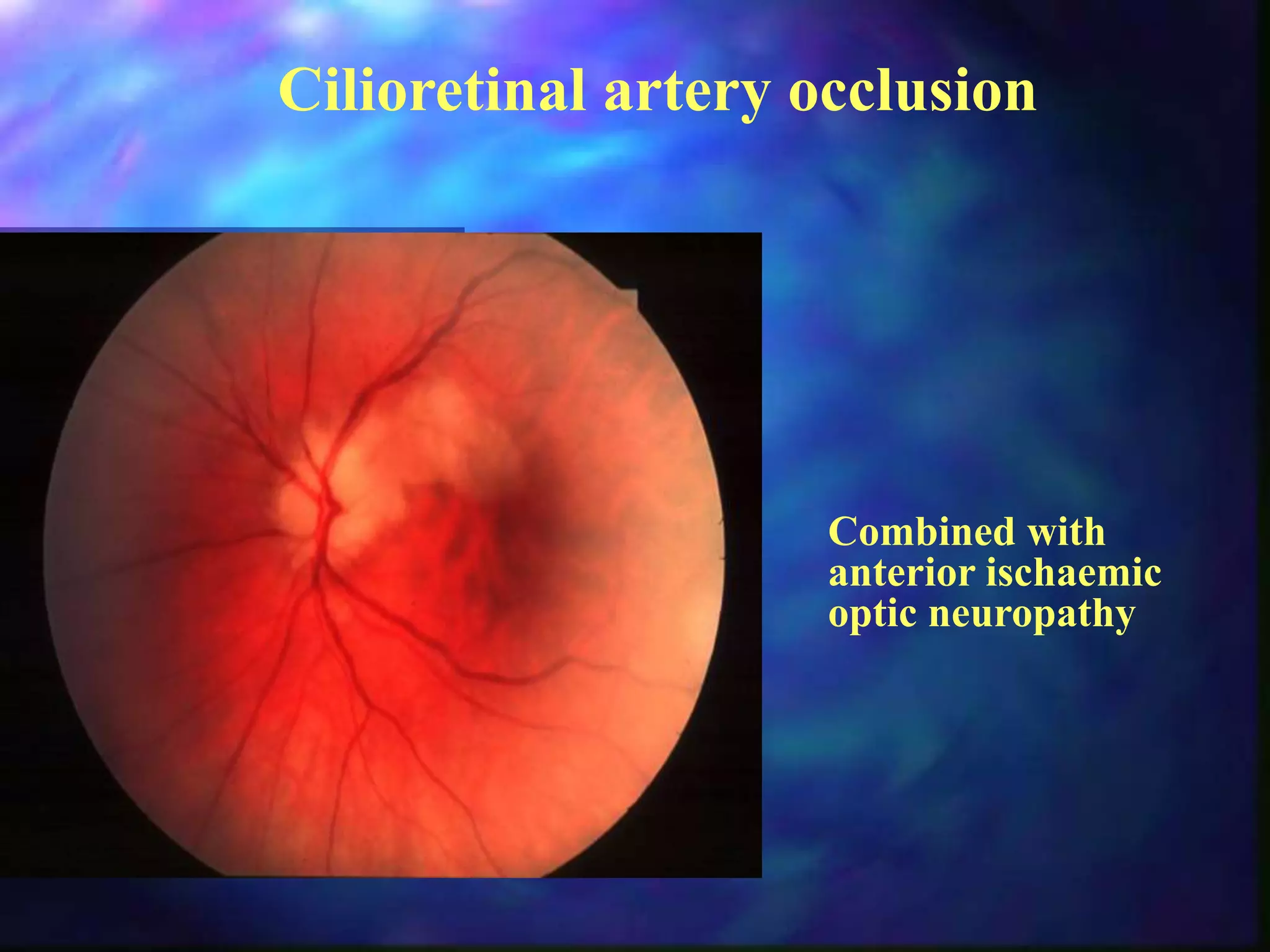 Hypertensive retinopathy | PPT
