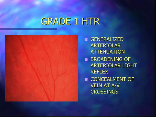Hypertensive retinopathy | PPT | Eye and Vision Conditions | Diseases ...