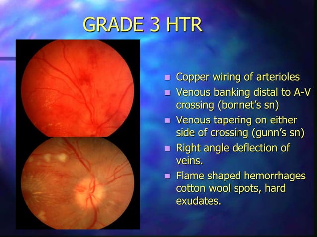 Hypertensive retinopathy | PPT | Eye and Vision Conditions | Diseases ...