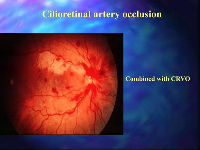 Hypertensive retinopathy | PPT | Eye and Vision Conditions | Diseases ...