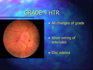 Hypertensive Retinopathy Silver Wiring