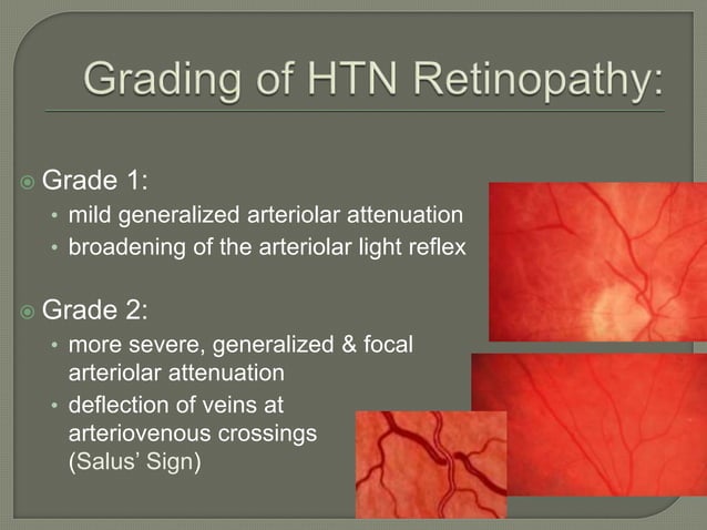 HYPERTENSIVE RETINOPATHY.pptx