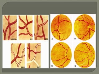 Hypertensive Retinopathy Silver Wiring