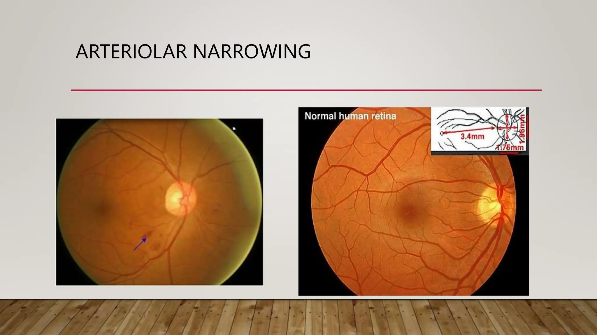 HYPERTENSIVE RETINOPATHY.2023 12111325246pptx | PPTX