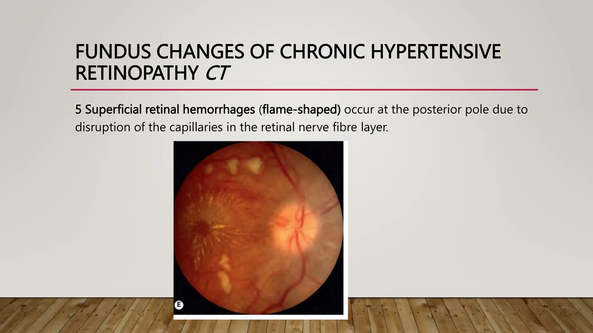 HYPERTENSIVE RETINOPATHY.2023 12111325246pptx | PPTX