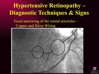 Hypertensive retinopathy.pptx for post graduates | PPT