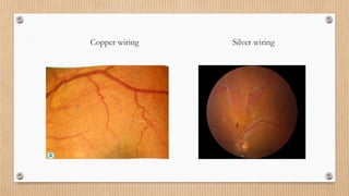 Morden opthalomology Hypertensive retinopathy.pptx