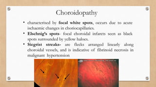 Morden opthalomology Hypertensive retinopathy.pptx