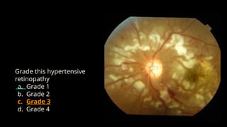 Hypertensive retinopathy by resident .pptx