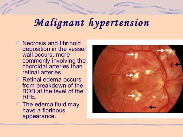 Hypertensive Retinopathy