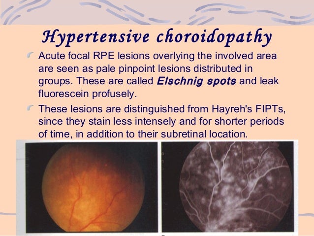Hypertensive Retinopathy